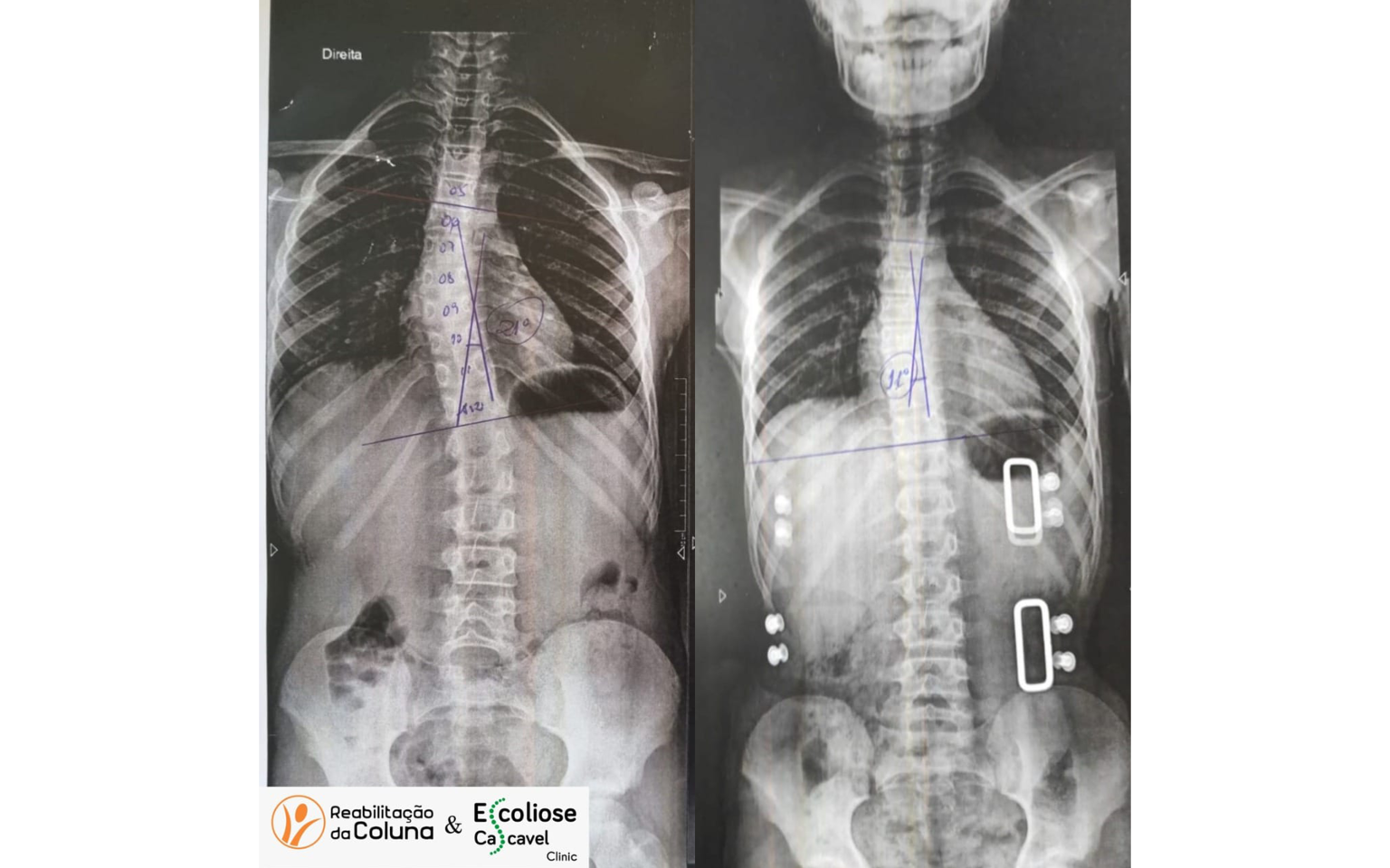 Escoliose, como identificar? – Nosso Blog